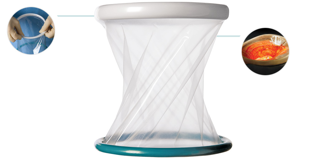 Alexis O Wound Protector/Retractor | Applied Medical