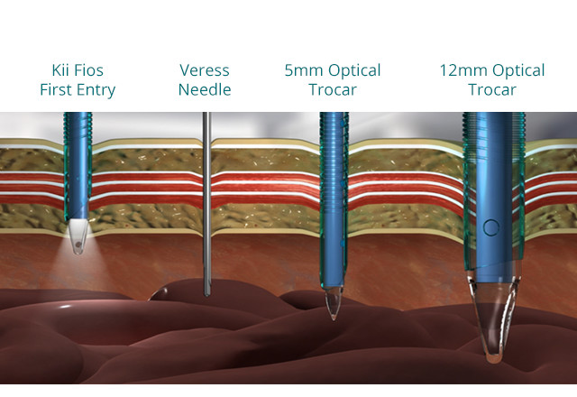Kii Fios First Entry Access System | Applied Medical